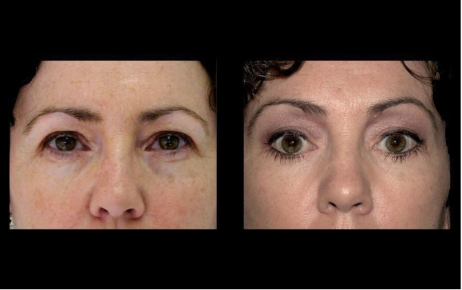 Eyelid Surgery | SKIN Oxford