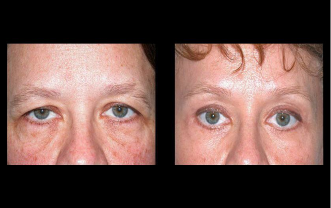 Eyelid Surgery | SKIN Oxford